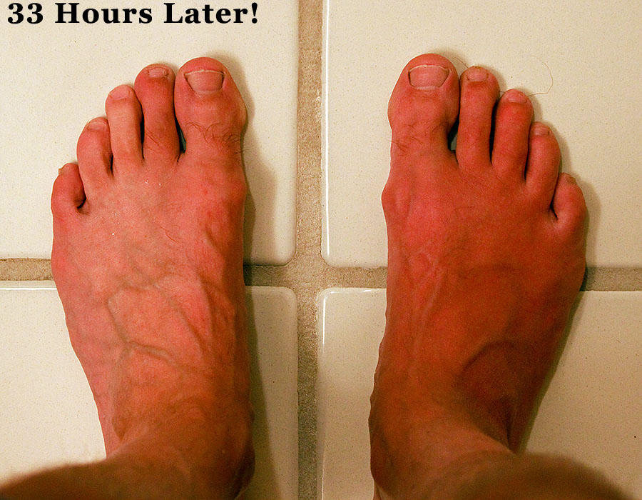 Bee Sting Swelling Ankle